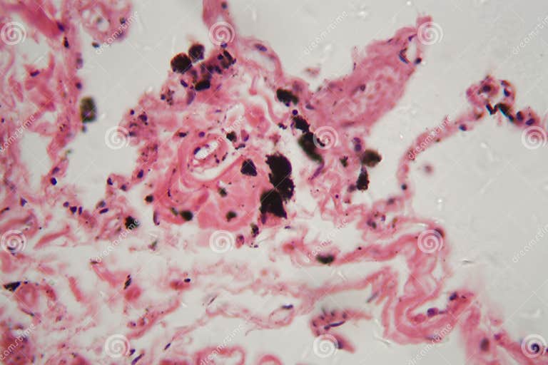 Human Lung Tissue with Dust and Coal Particles Under the Microscope ...