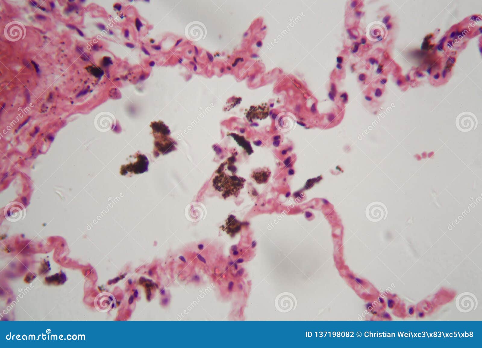 Human Lung Tissue with Dust and Coal Particles Under the Microscope ...