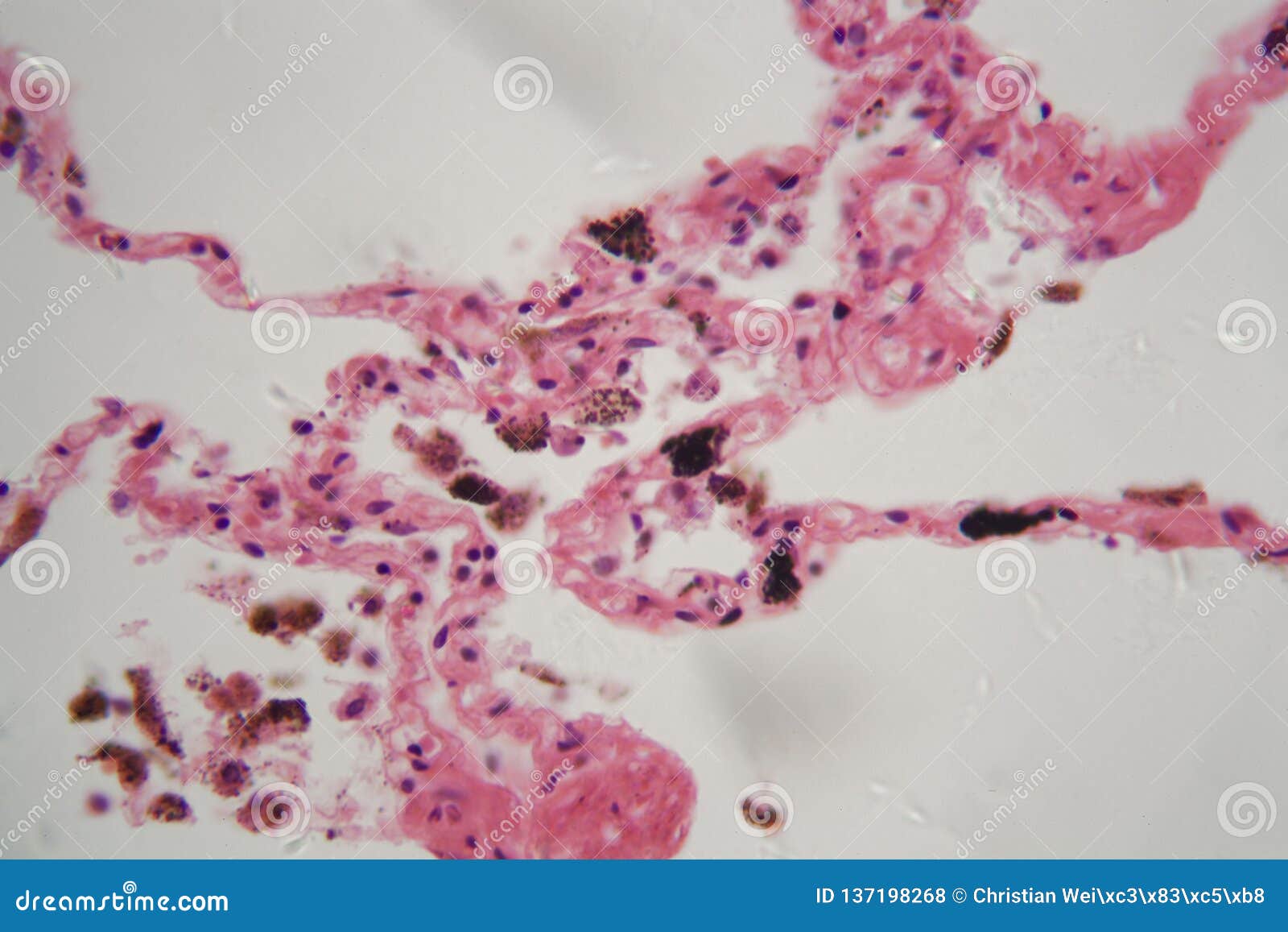 Human Lung Tissue with Dust and Coal Particles Under the Microscope ...