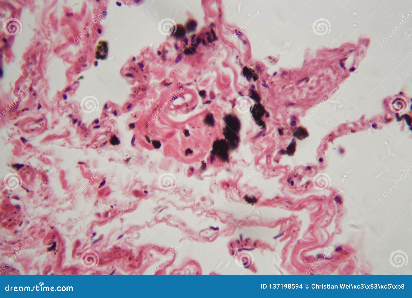 Human Lung Tissue with Dust and Coal Particles Under the Microscope ...