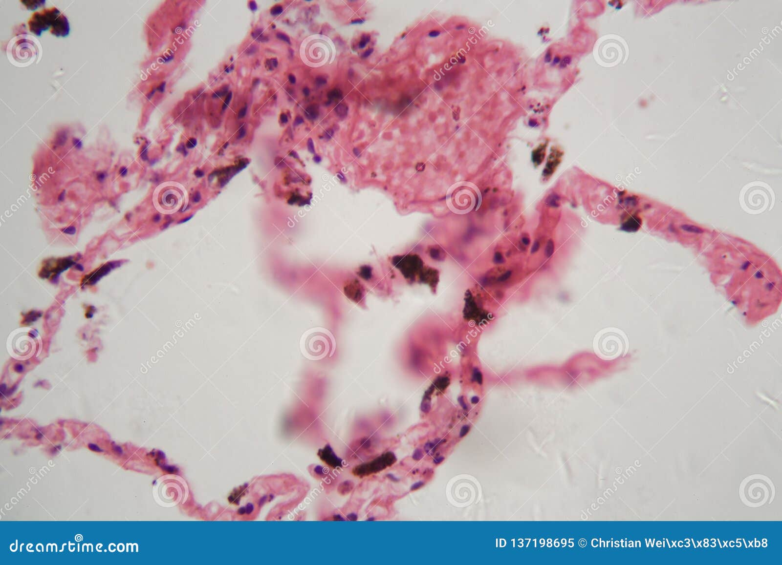 Human Lung Tissue with Dust and Coal Particles Under the Microscope ...