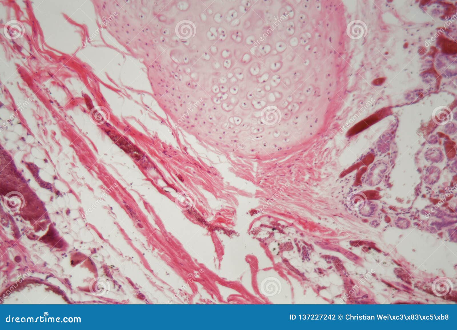 Human Lung Tissue with Pulmonary Embolism Under a Microscope Stock ...