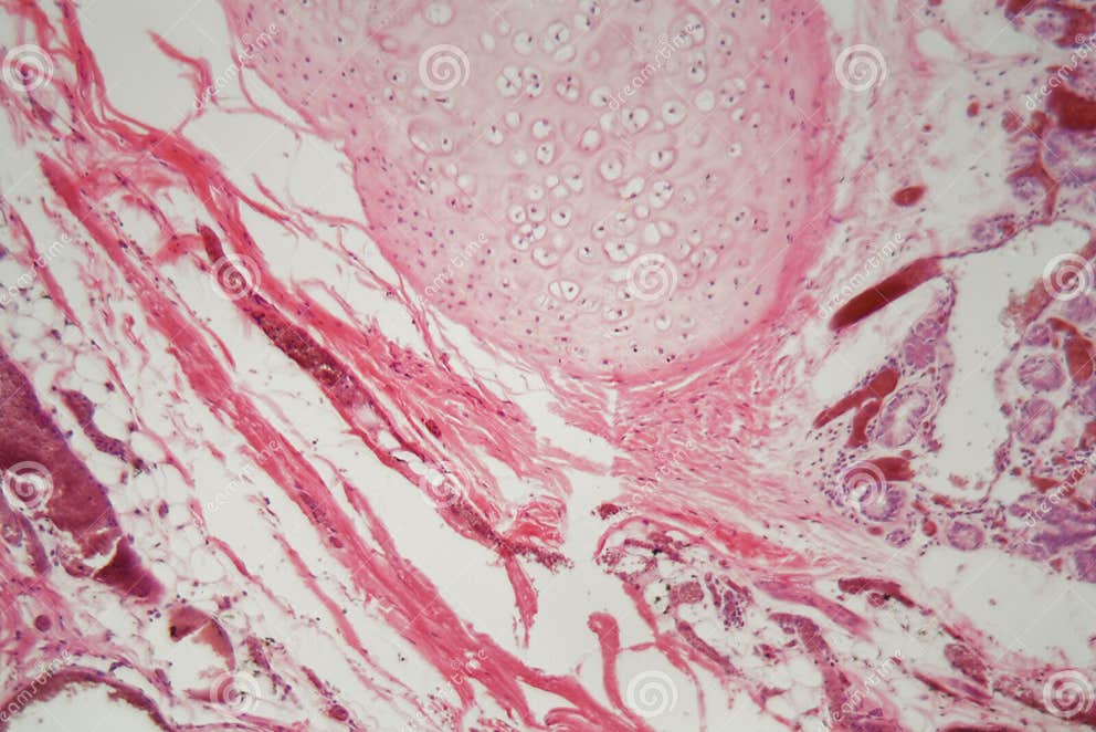 Human Lung Tissue with Pulmonary Embolism Under a Microscope Stock ...