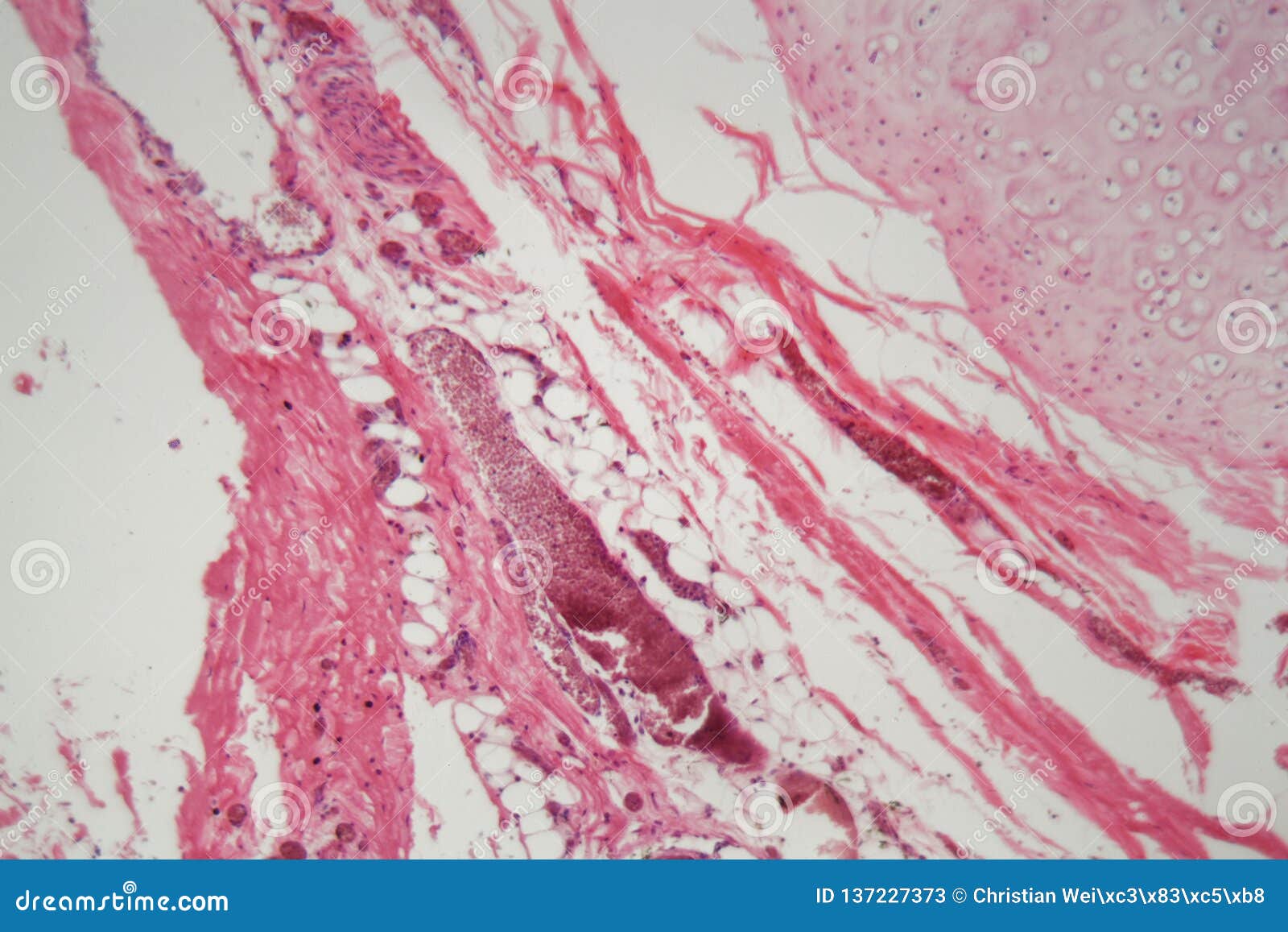 Human Lung Tissue with Pulmonary Embolism Under a Microscope Stock ...