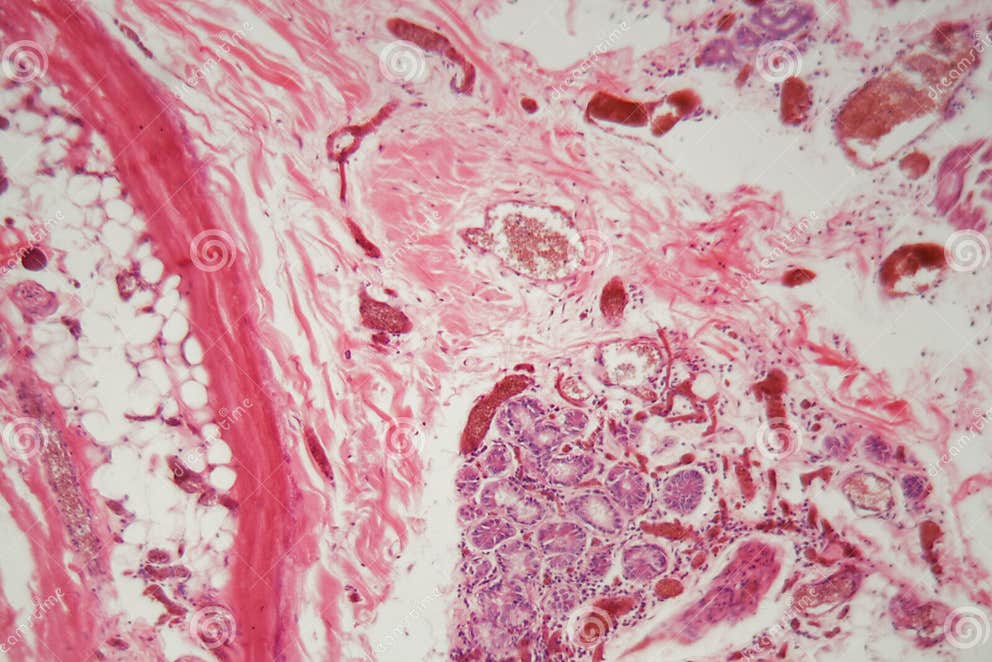 Human Lung Tissue with Pulmonary Embolism Under a Microscope Stock ...