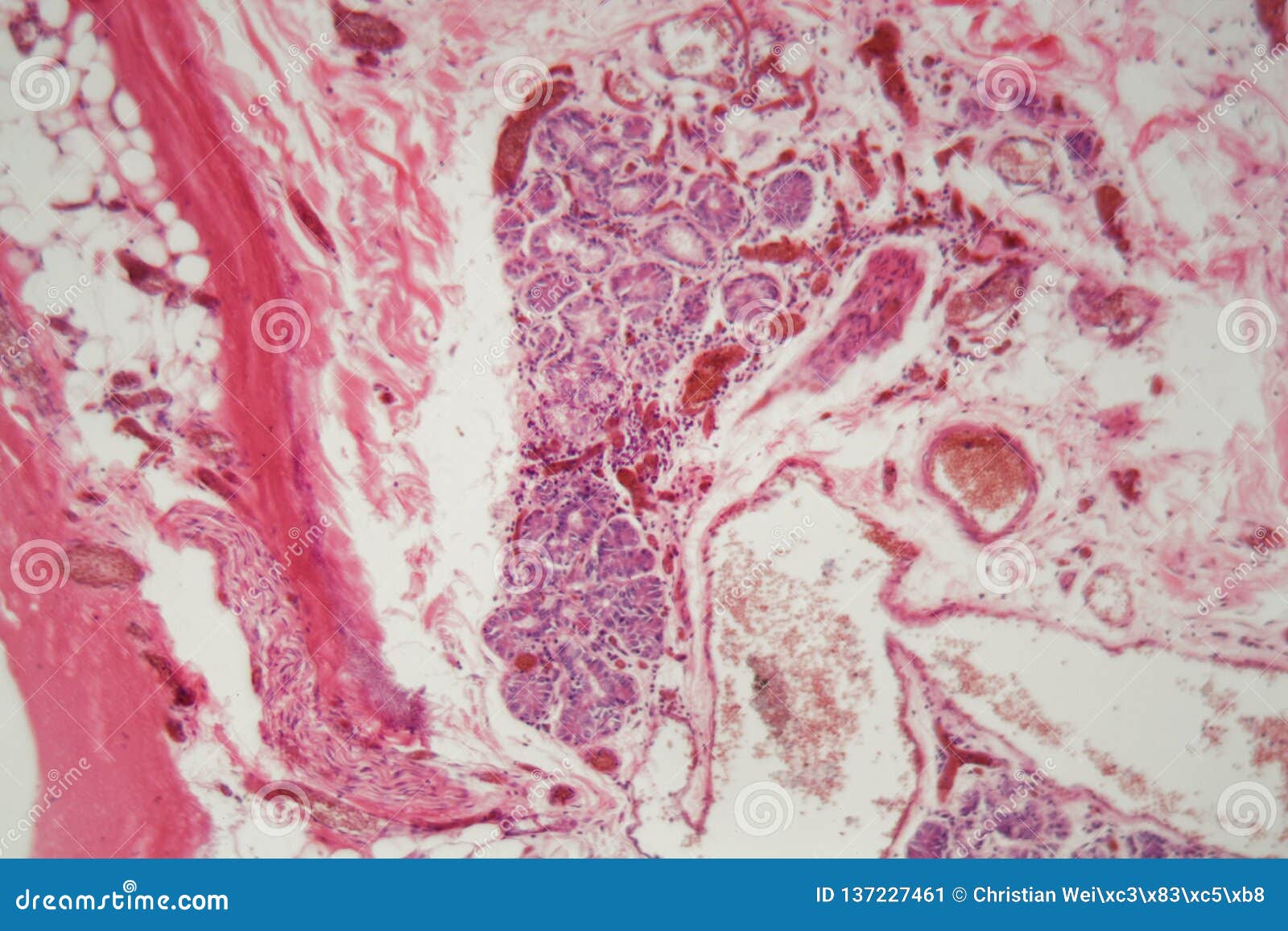 Human Lung Tissue with Pulmonary Embolism Under a Microscope Stock ...