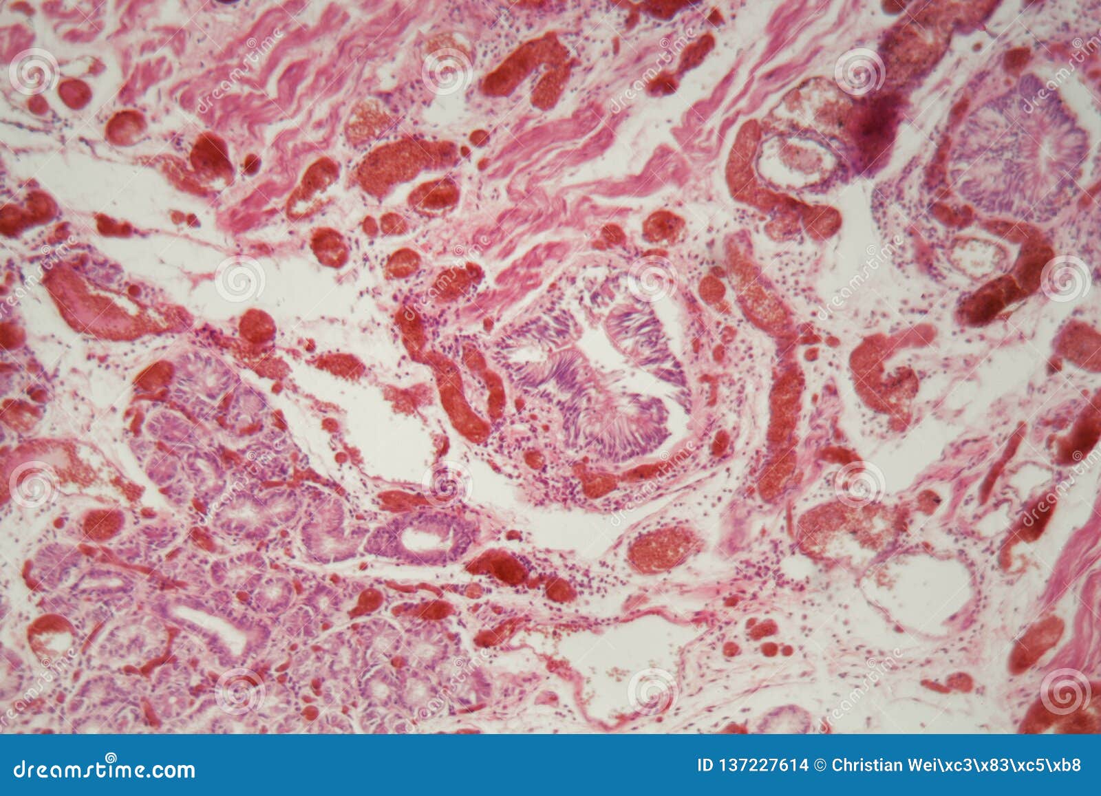 Human Lung Tissue with Pulmonary Embolism Under a Microscope Stock ...