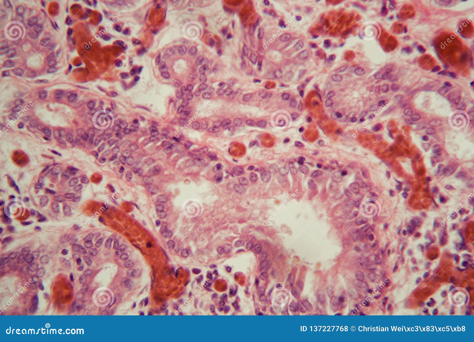 Human Lung Tissue with Pulmonary Embolism Under a Microscope Stock ...