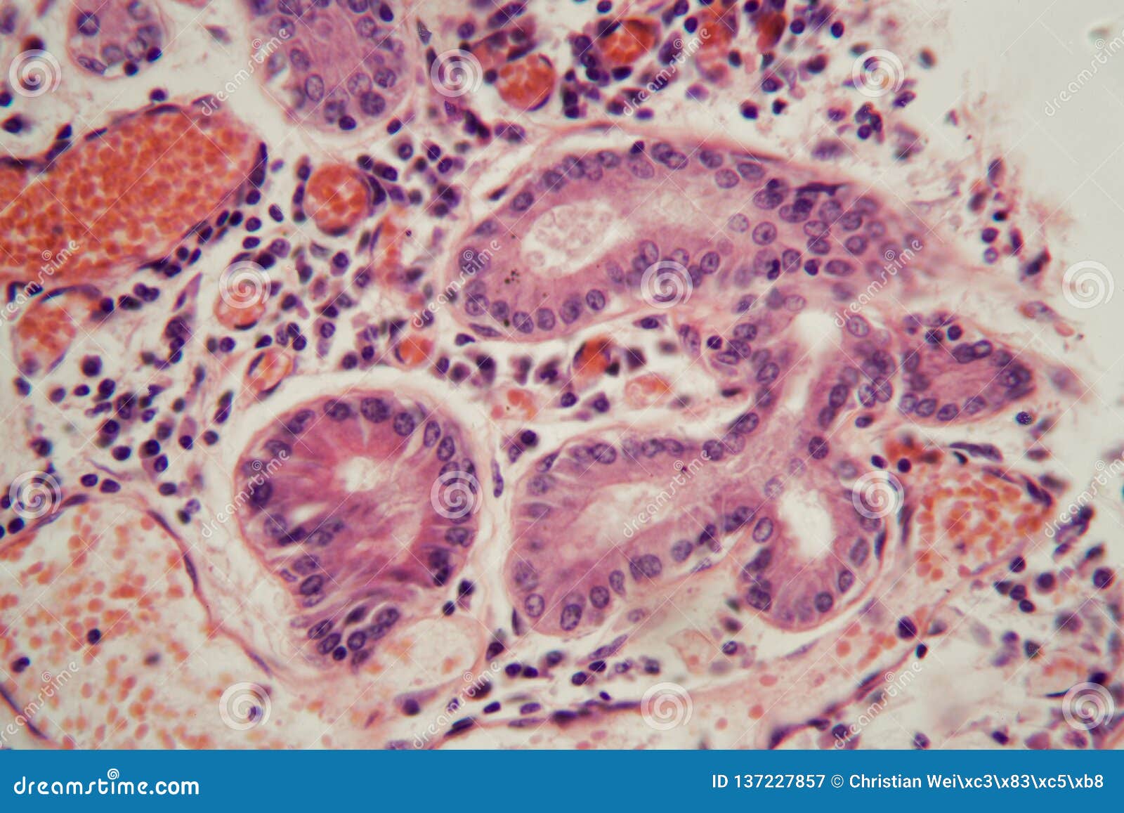 Human Lung Tissue with Pulmonary Embolism Under a Microscope Stock ...