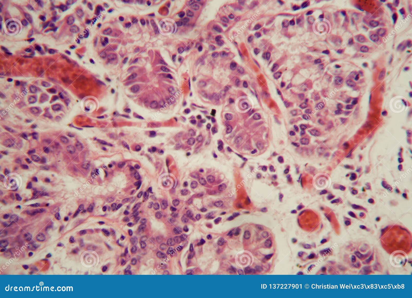 Human Lung Tissue with Pulmonary Embolism Under a Microscope Stock ...