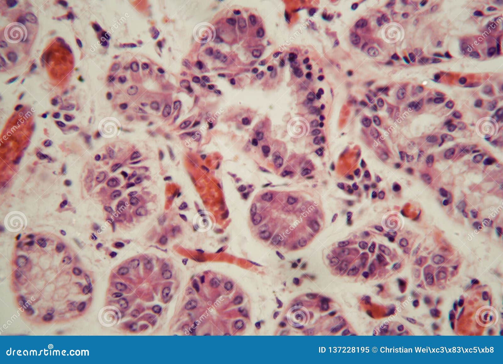 Human Lung Tissue with Pulmonary Embolism Under a Microscope Stock ...