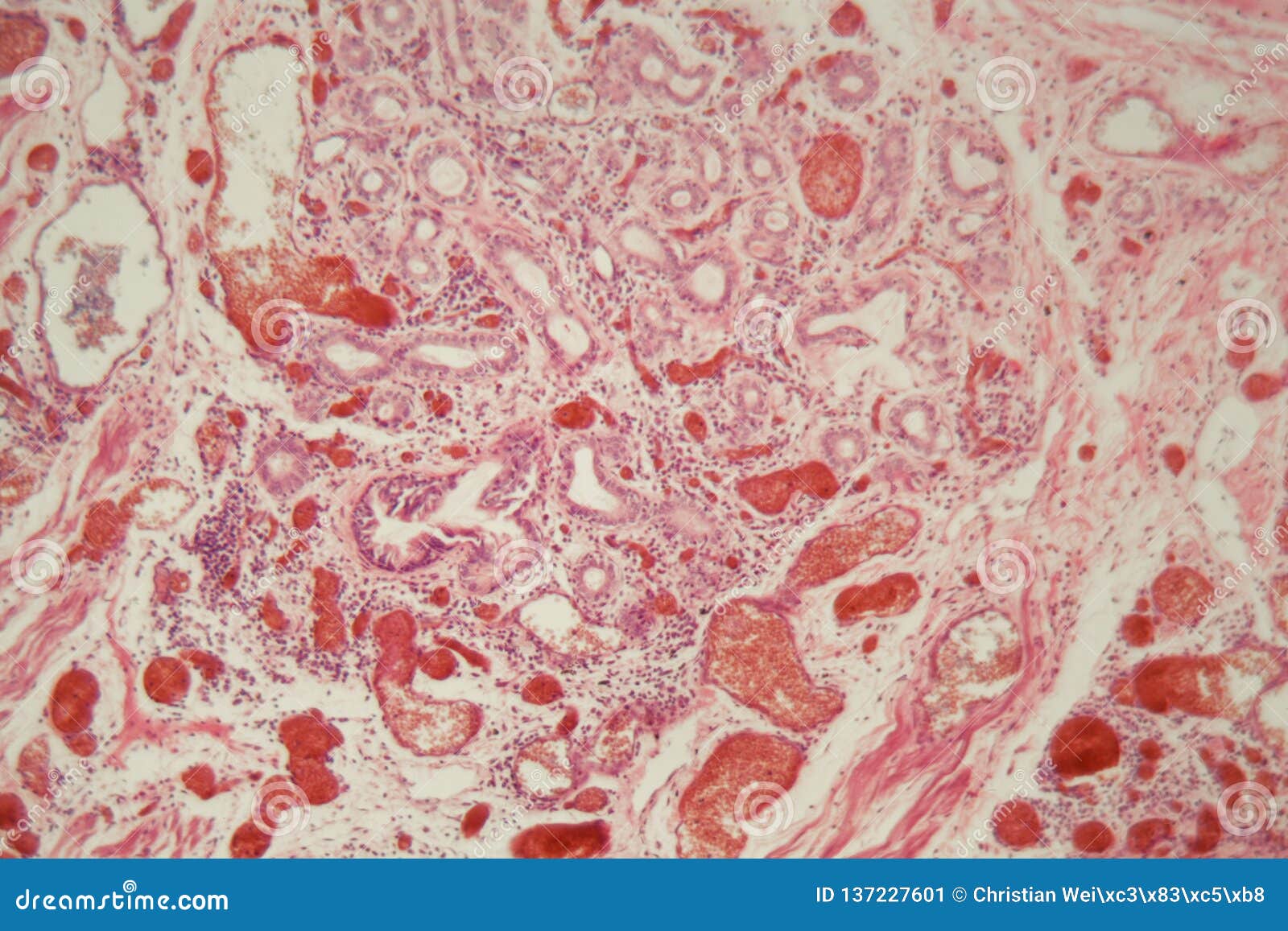 Human Lung Tissue with Pulmonary Embolism Under a Microscope Stock ...
