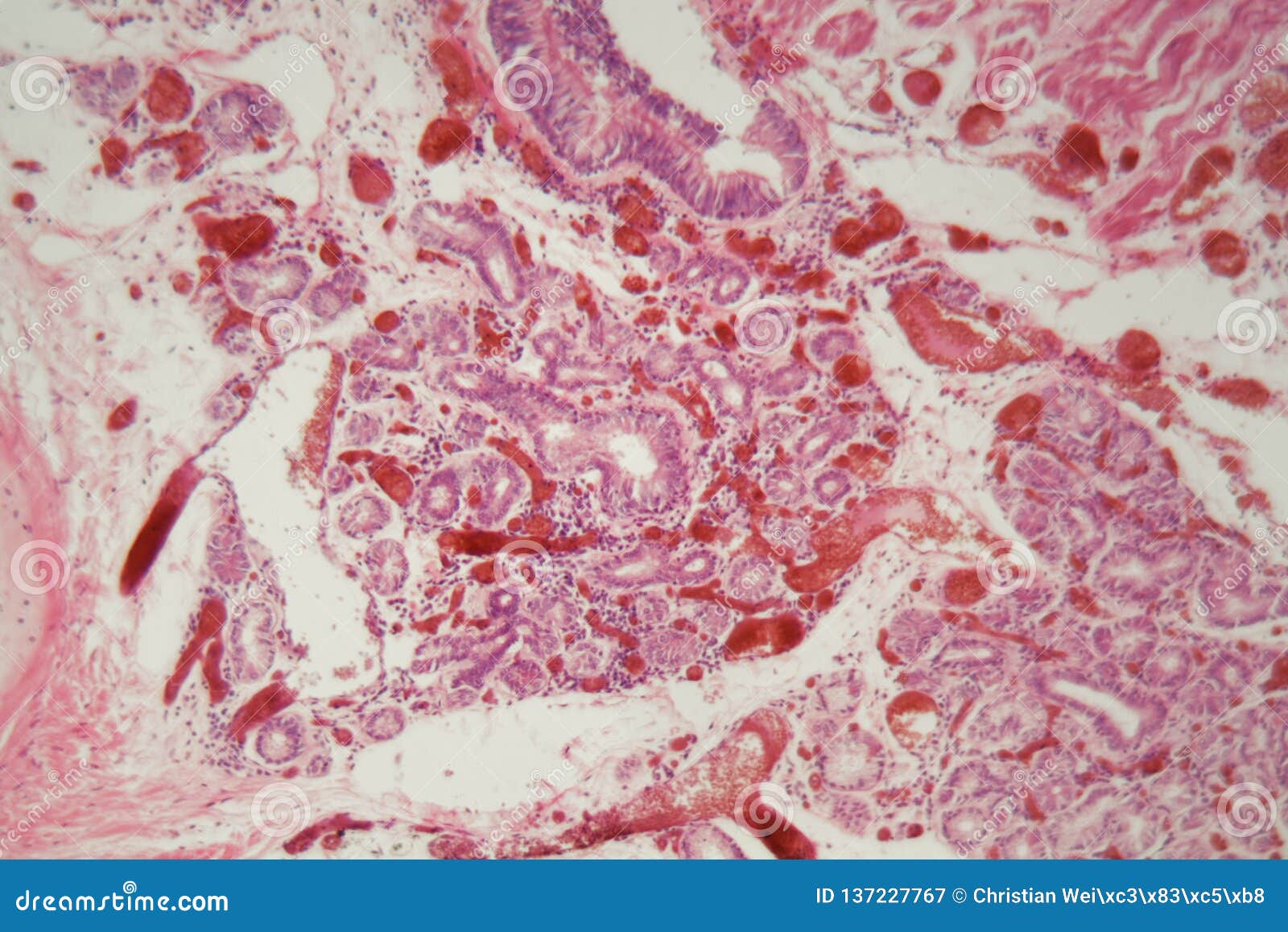 Human Lung Tissue with Pulmonary Embolism Under a Microscope Stock ...