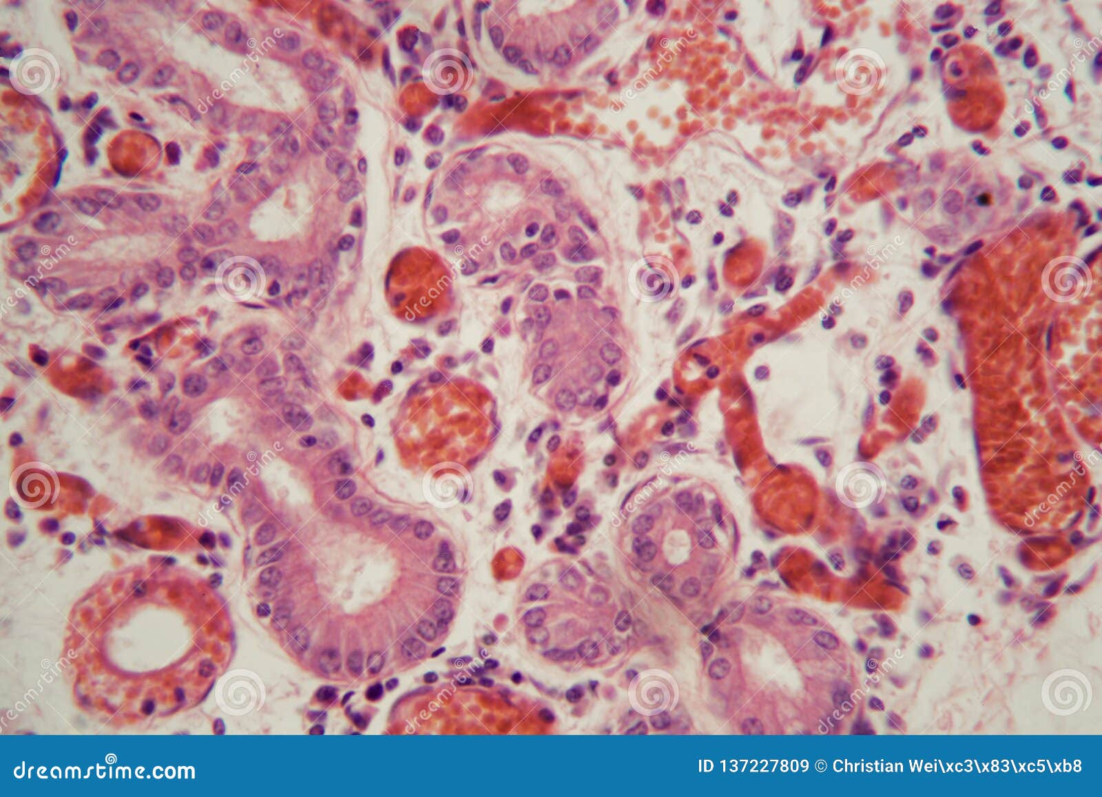 Human Lung Tissue with Pulmonary Embolism Under a Microscope Stock ...