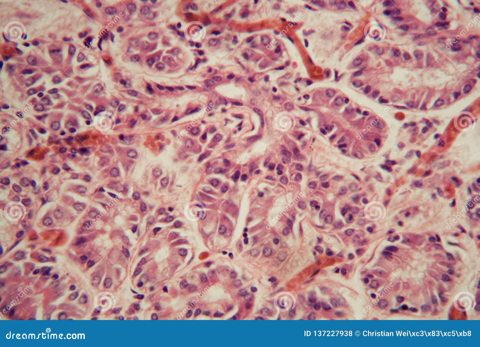 Human Lung Tissue with Pulmonary Embolism Under a Microscope Stock ...