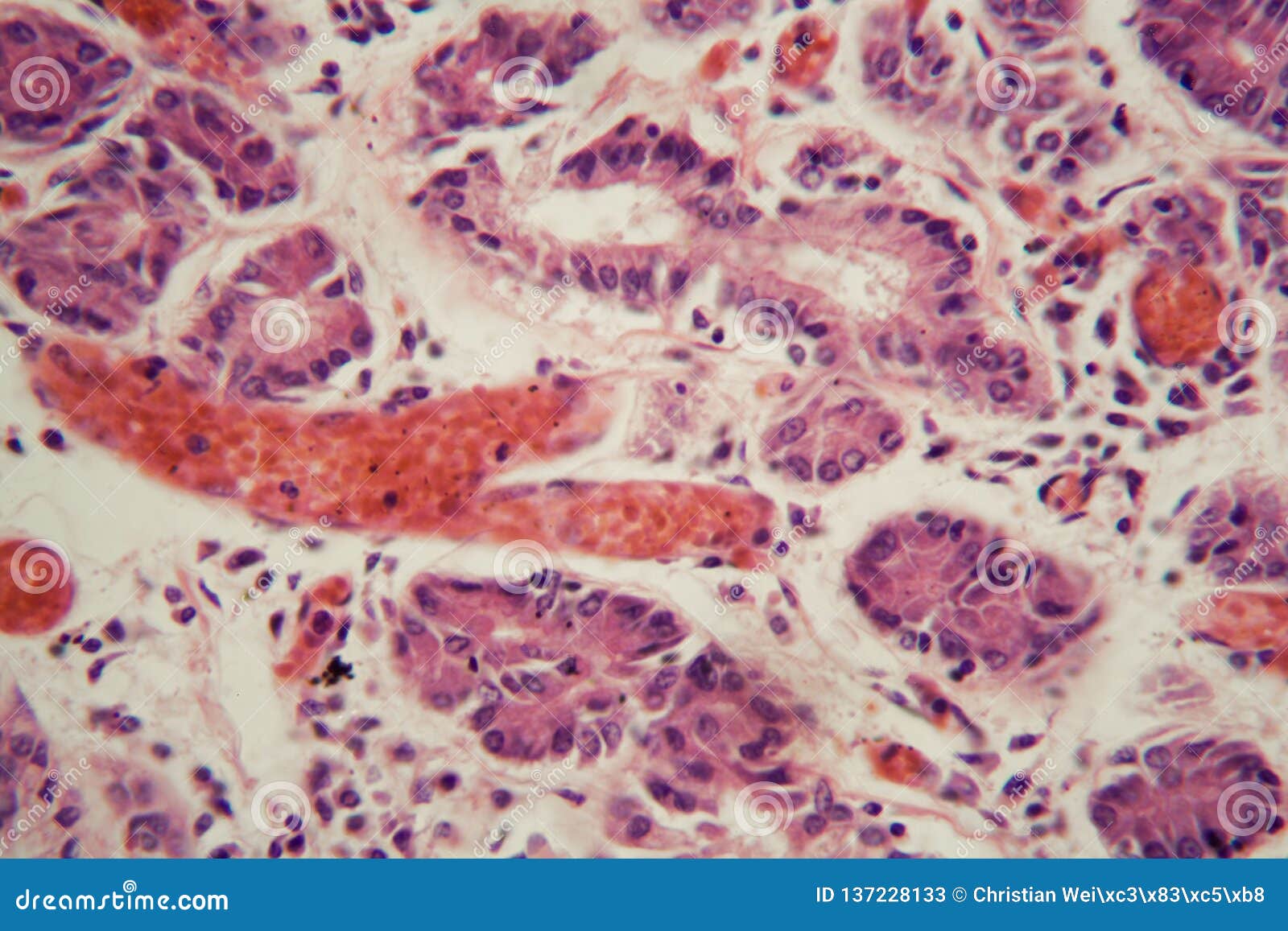 Human Lung Tissue with Pulmonary Embolism Under a Microscope Stock ...