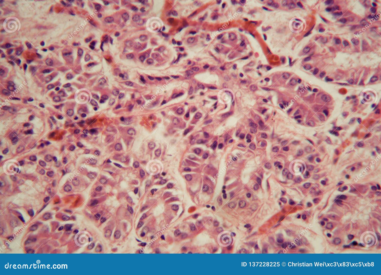 Human Lung Tissue with Pulmonary Embolism Under a Microscope Stock ...