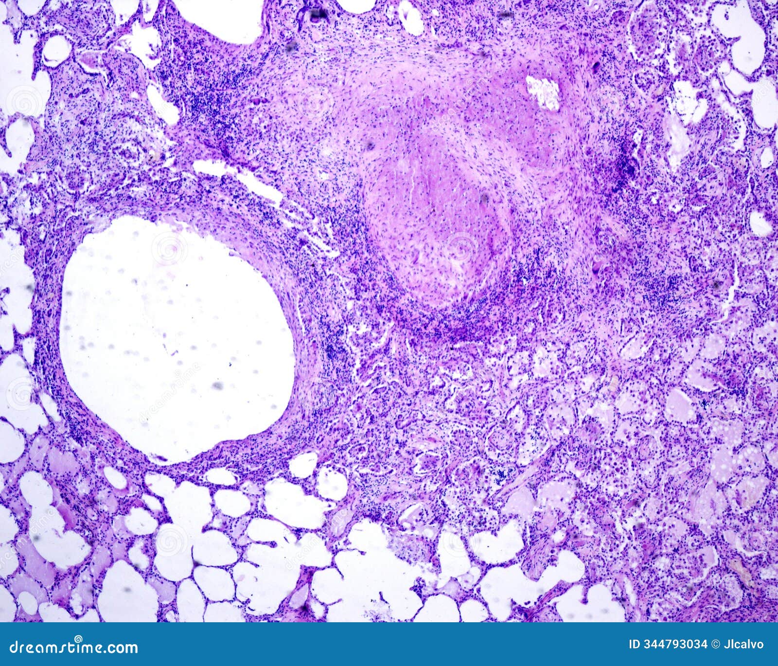 Human Lung. Tuberculosis Granuloma Stock Photo - Image of micrograph ...