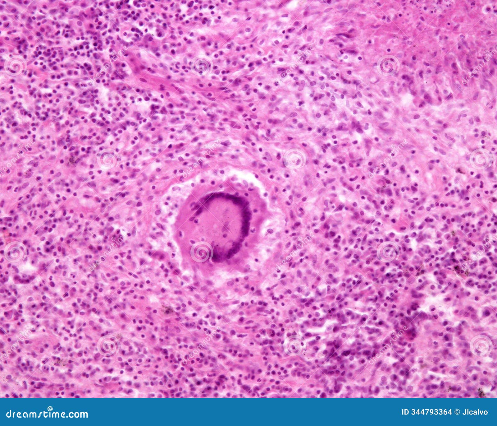 Human Lung. Tuberculosis, Langhans Giant Cells Stock Photo - Image of ...