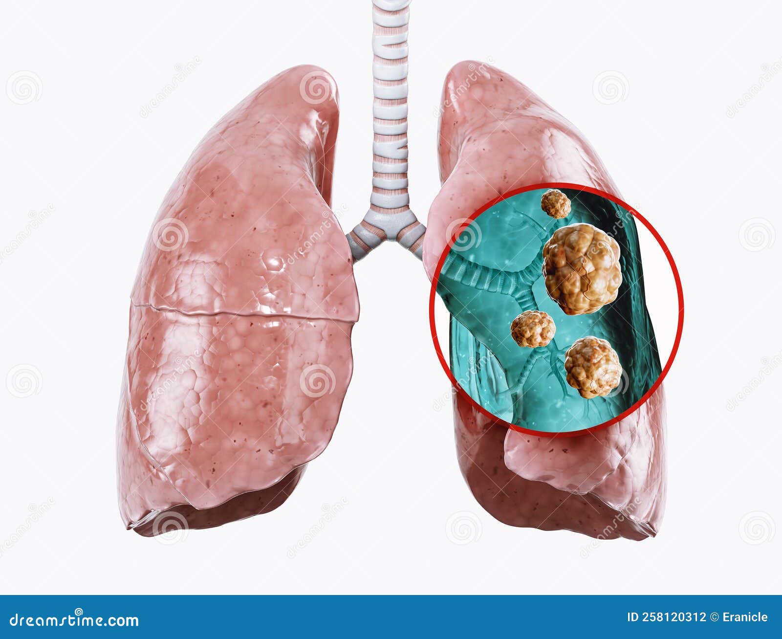 Human Lungs Damaged by Cancer Stock Illustration - Illustration of ...