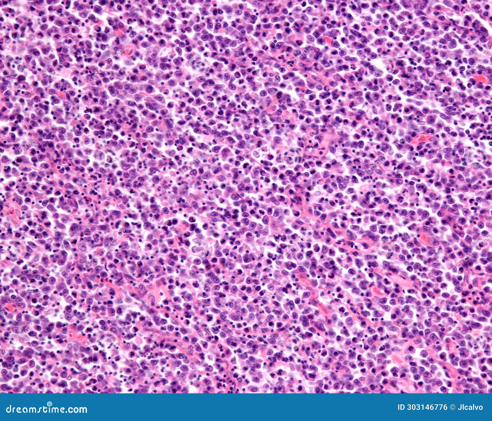 Human Lymph Node. Metastasis Of Malignant Melanoma Stock Photography ...