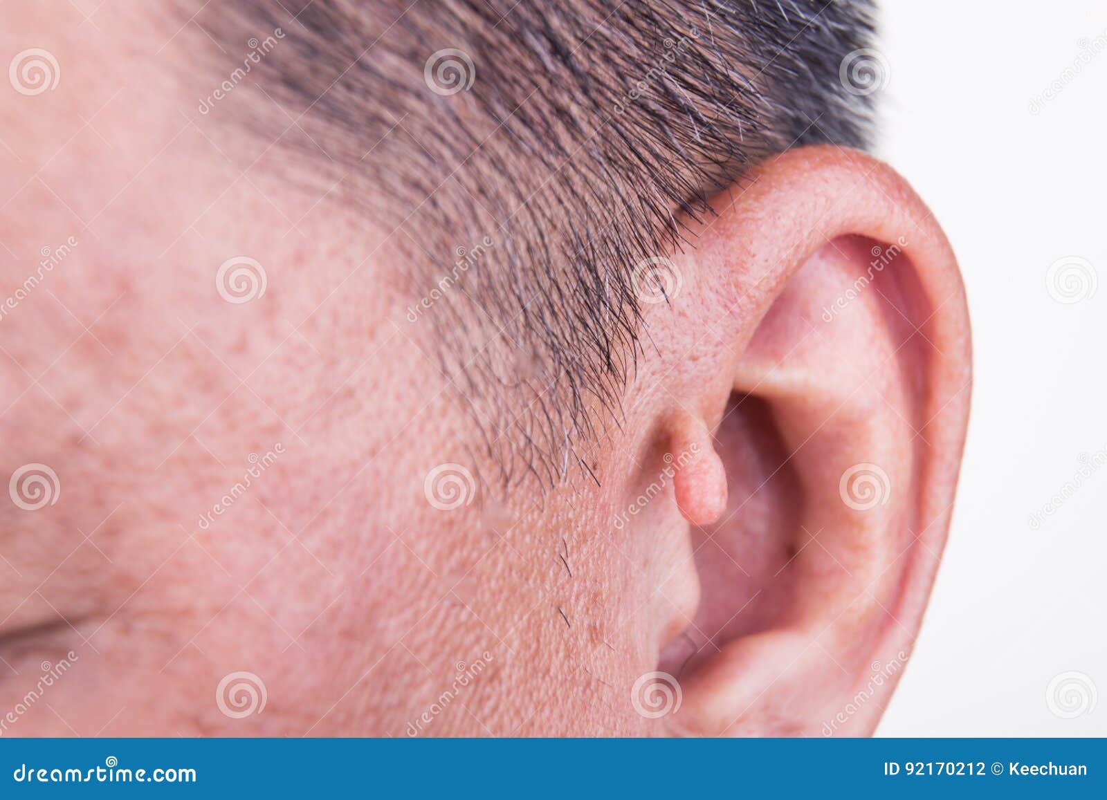 Human Mutation with Extra Growth on Ear Stock Photo - Image of growth ...