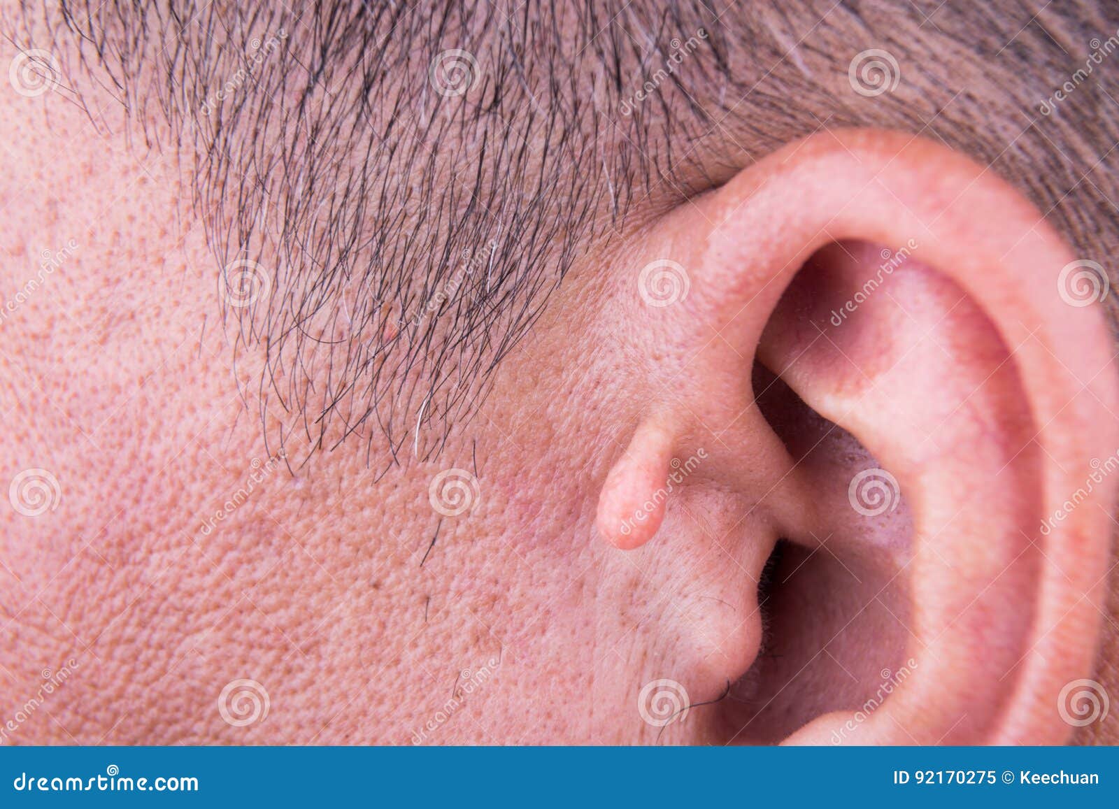 Human Mutation with Extra Growth on Ear Stock Image - Image of gene ...