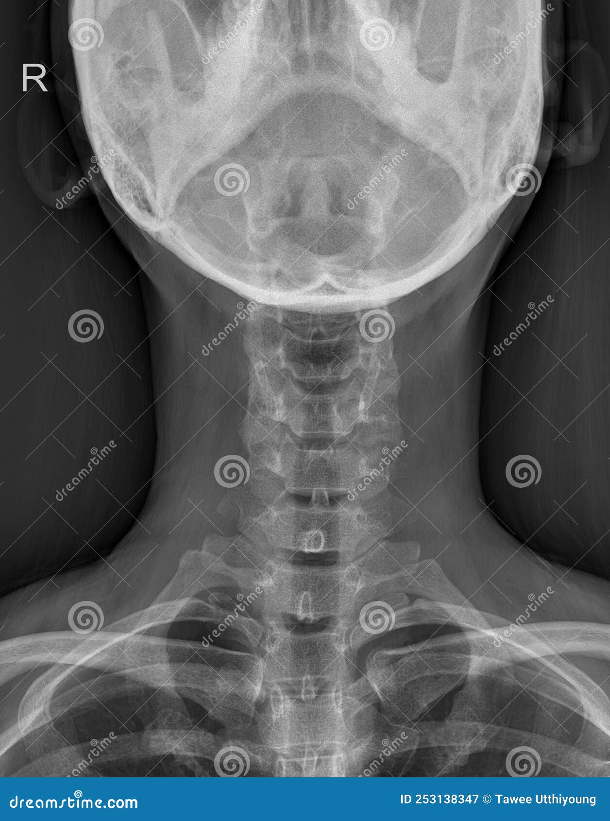 Human neck CT scan image stock image. Image of bone - 253138347