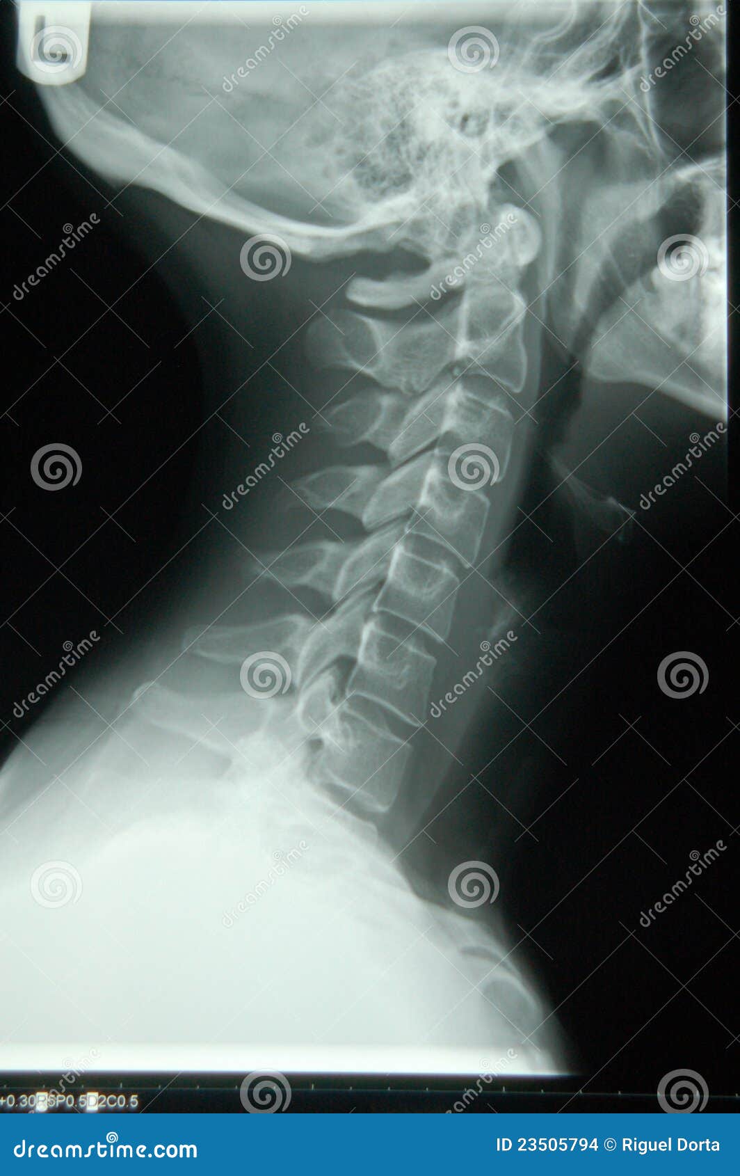 Human Neck X-ray Stock Images - Image: 23505794