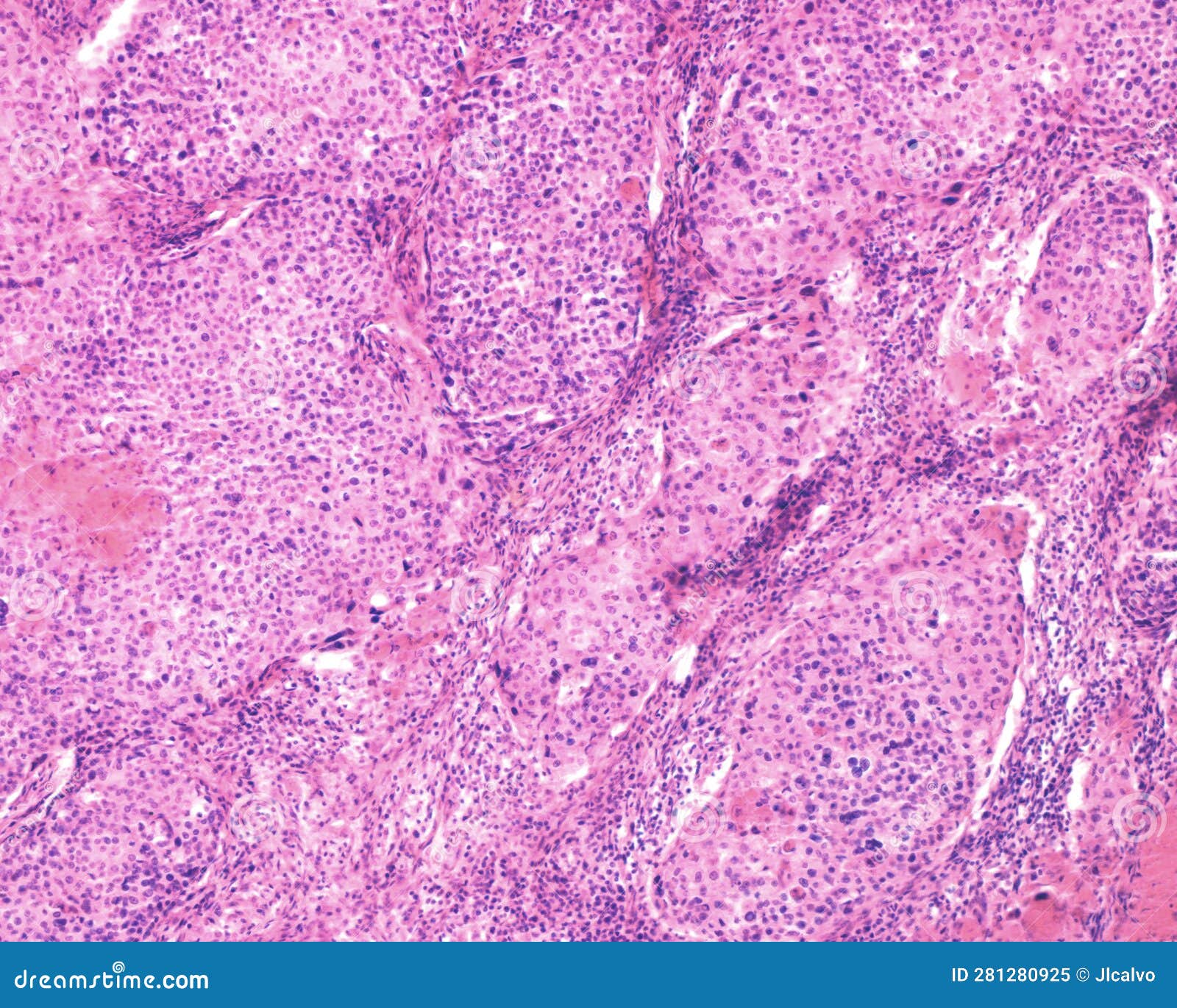 Tumor Cells Under A Microscope. Tissues Affected By Cancer Cells Under ...