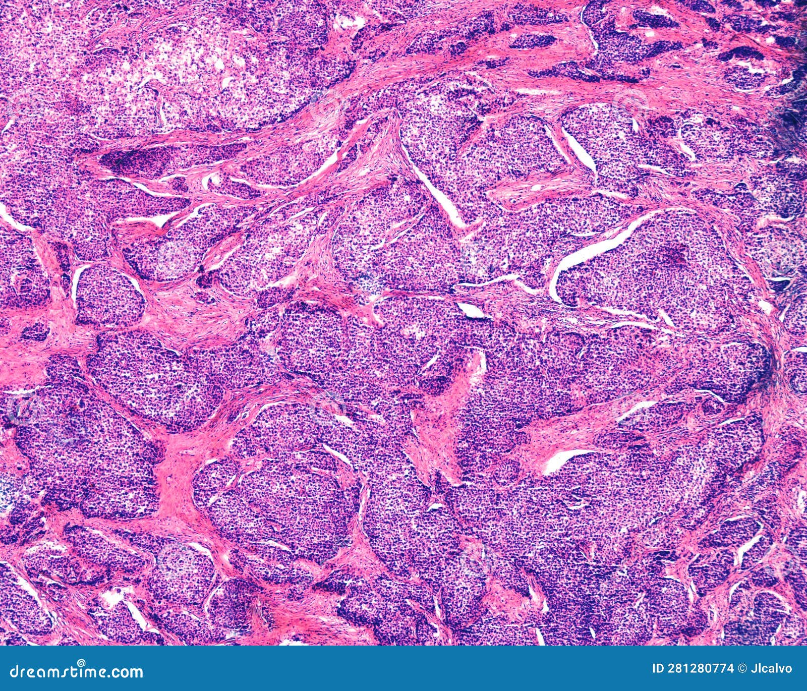 Tumor Cells Under A Microscope. Tissues Affected By Cancer Cells Under ...