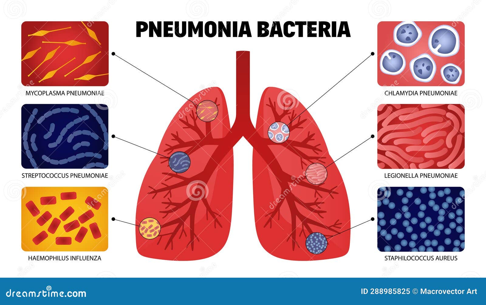 Human Pneumonia Infographic Set Vector Illustration | CartoonDealer.com ...