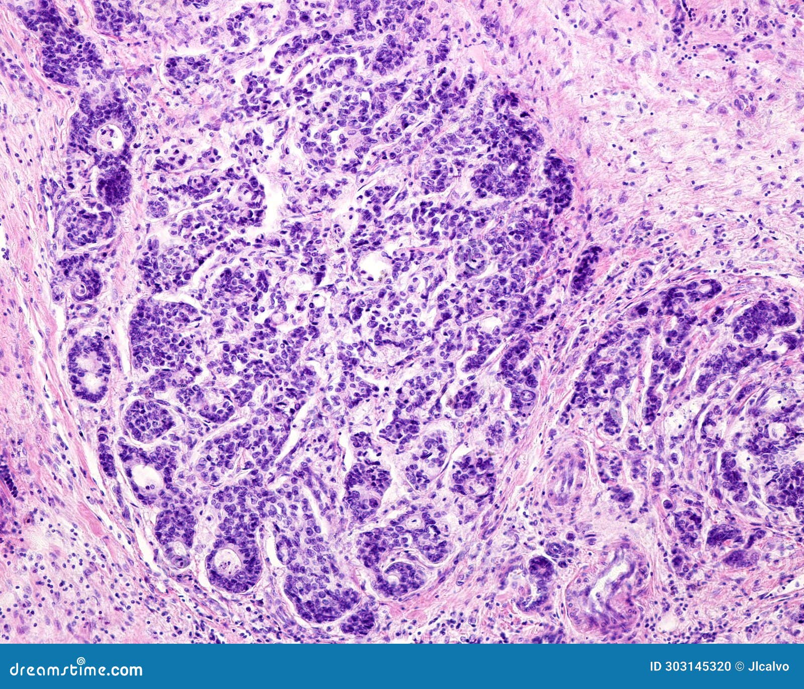 Human Prostate Cancer. Adenocarcinoma Stock Photo - Image of human ...
