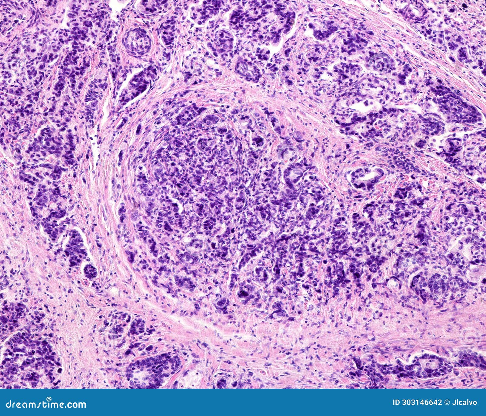 Human Prostate Cancer. Adenocarcinoma Stock Photo - Image of ...