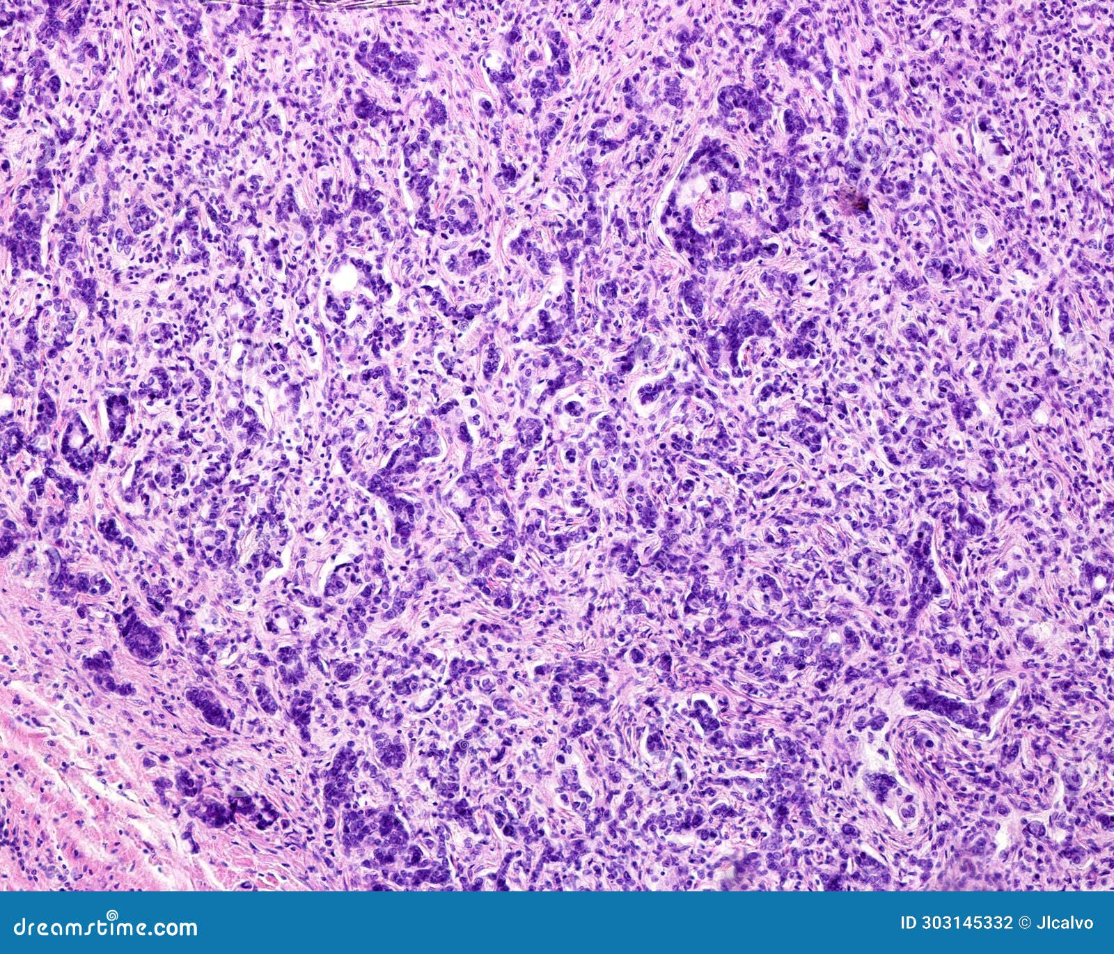 Human Prostate Cancer. Adenocarcinoma Stock Photo - Image of prostate ...