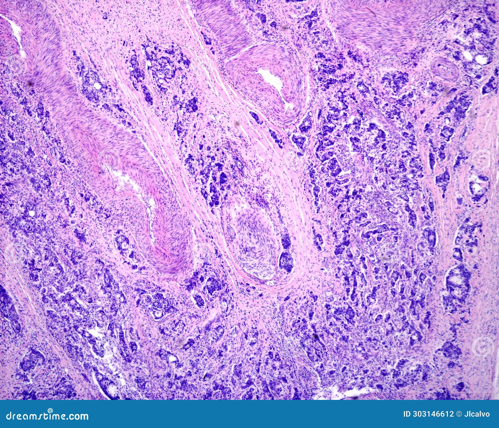 Human Prostate Cancer. Adenocarcinoma Stock Photo - Image of ...