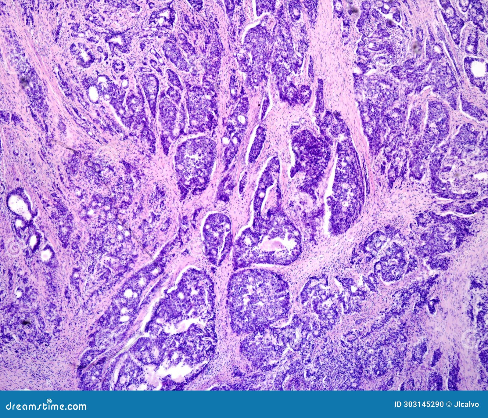 Human Prostate Cancer. Adenocarcinoma Stock Photo - Image of microscope ...