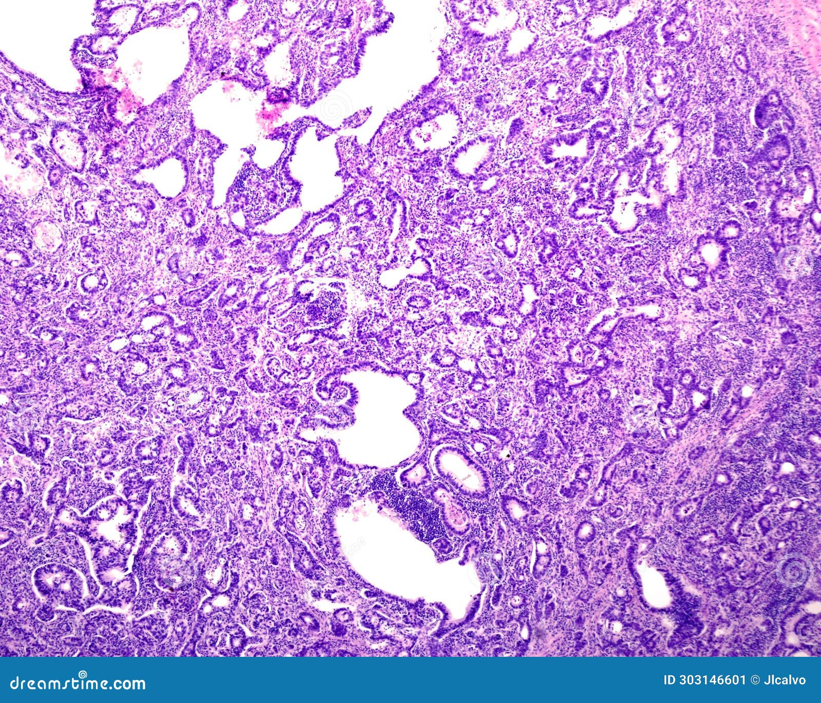 Human Prostate Cancer. Adenocarcinoma Stock Image - Image of oncology ...