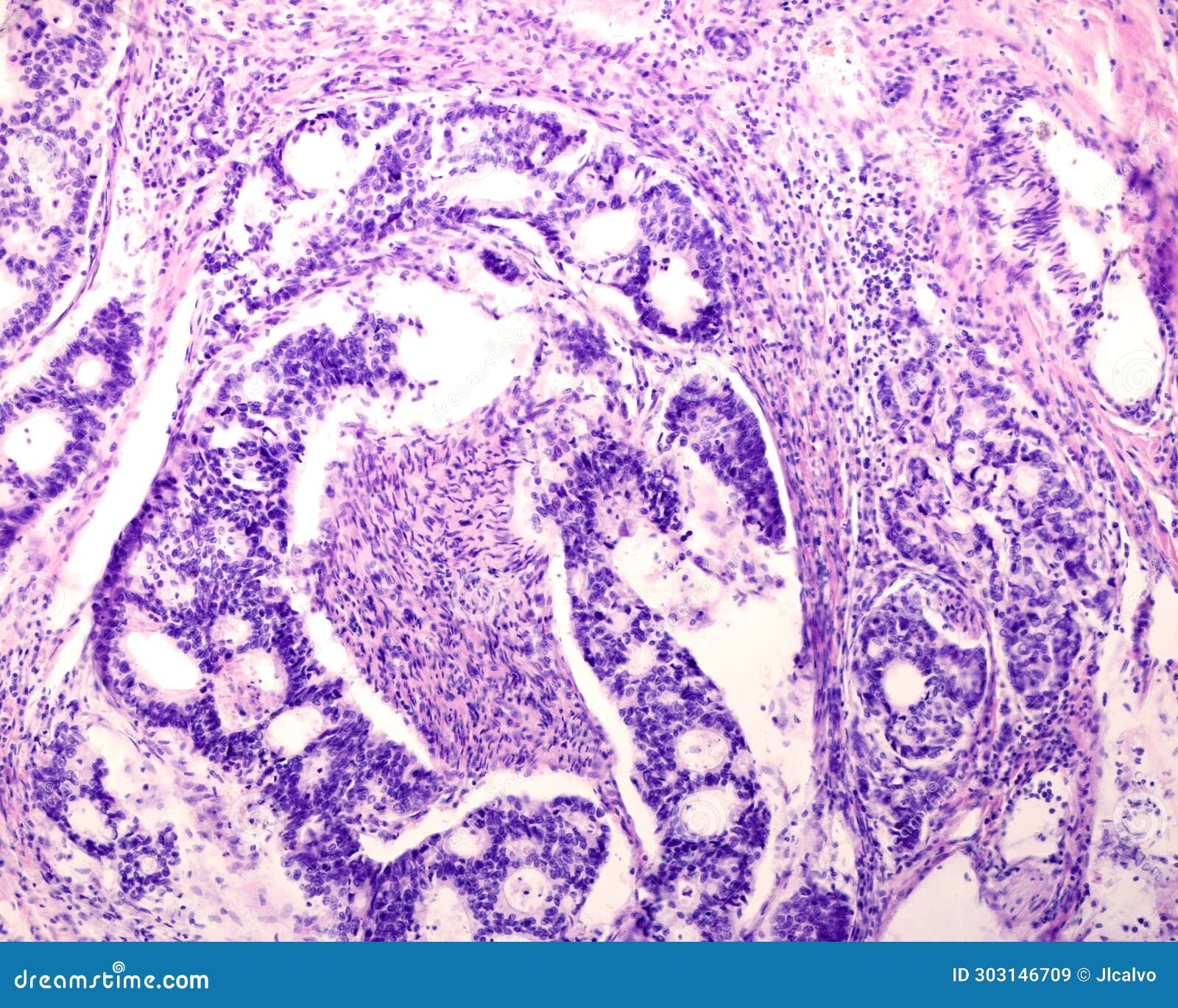 Human Prostate Cancer. Adenocarcinoma Stock Image - Image of microscopy ...