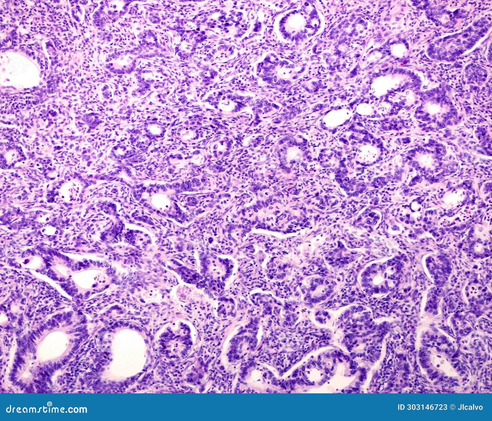 Human Prostate Cancer. Adenocarcinoma Stock Image - Image of cancerous ...