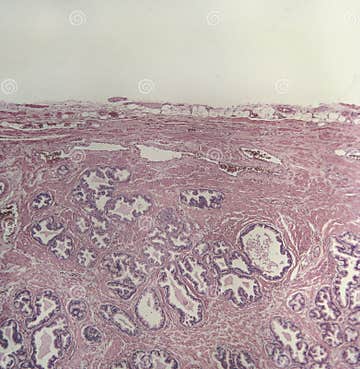 Human Prostate Gland, Microscopic Stock Image - Image of benign, cancer ...