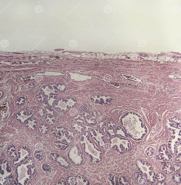 Human Prostate Gland, Microscopic Stock Image - Image of benign, cancer ...