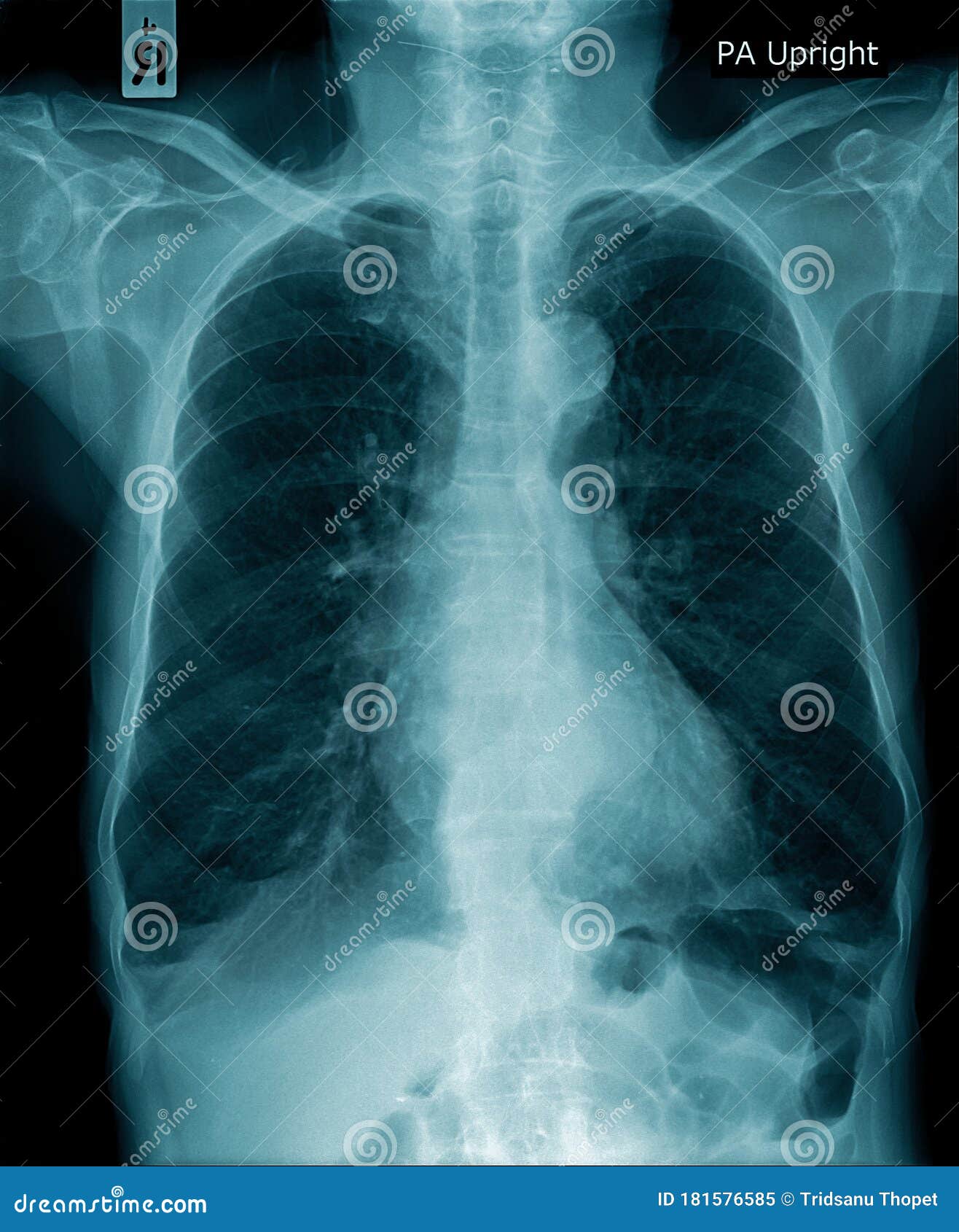 Human X-ray Image, Chest X-ray Stock Image - Image of diagnostic ...