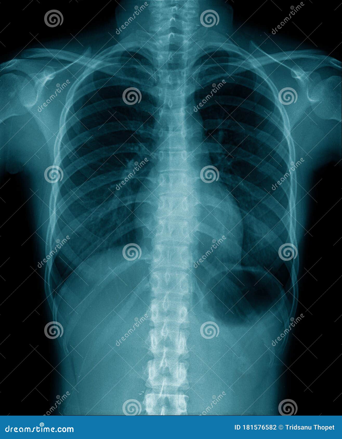 Chest X-ray Show Inside of Lung Stock Photo - Image of checkup, exam ...