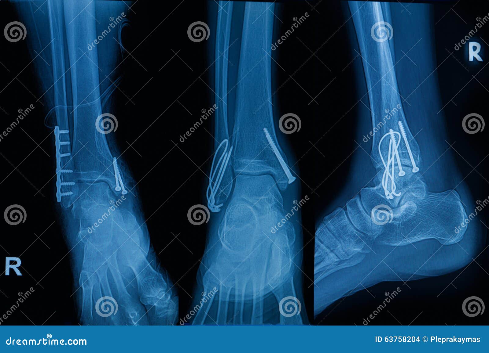 Human X-rays Showing Fracture of Right Leg Stock Photo - Image of crash ...