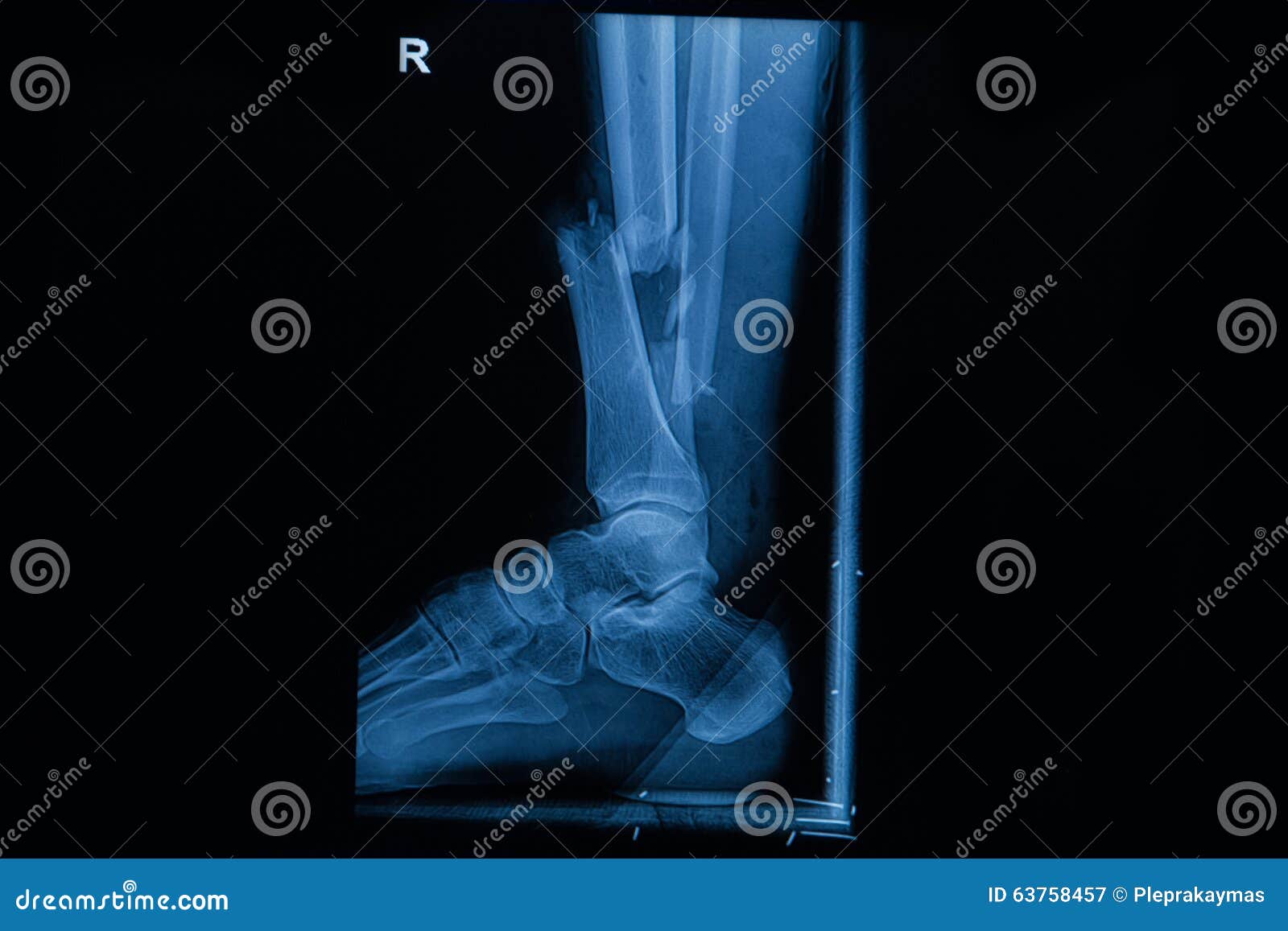 Human X-rays Showing Fracture Of Right Leg Stock Image - Image of ...