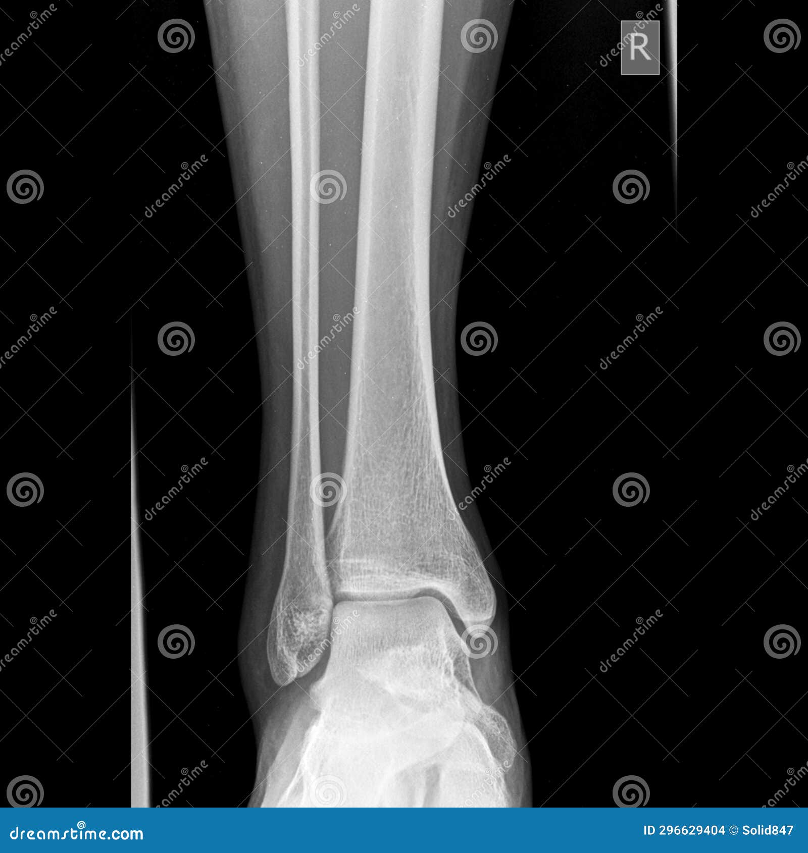 Ankle Joint X-ray Image AP View Stock Photo - Image of limb, bones ...