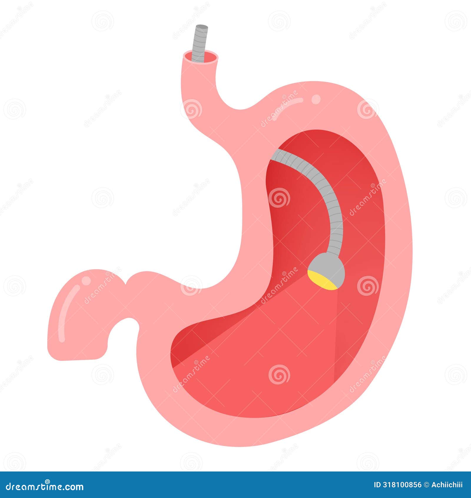 Human S Stomach, Stomach Endoscopy. Stock Vector - Illustration of ...