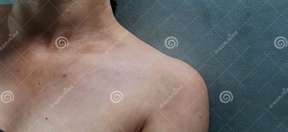 Human Shoulder with Moles Pimples Stretch Marks Pigmentation Stock ...