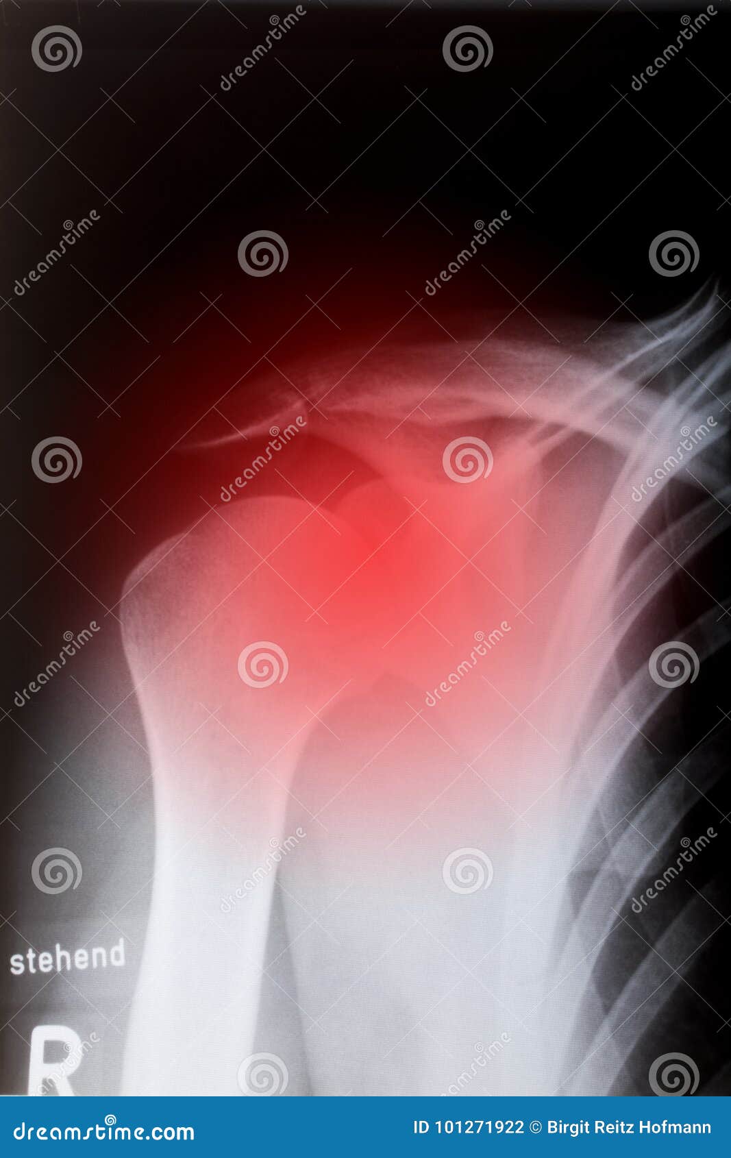 Human shoulder stock photo. Image of aufnahme, skelett - 101271922